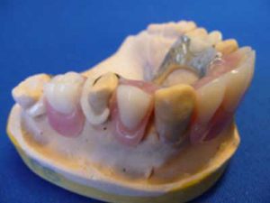 Dental ‘D’ clasps – Devonshire House Denture Solutions Ltd